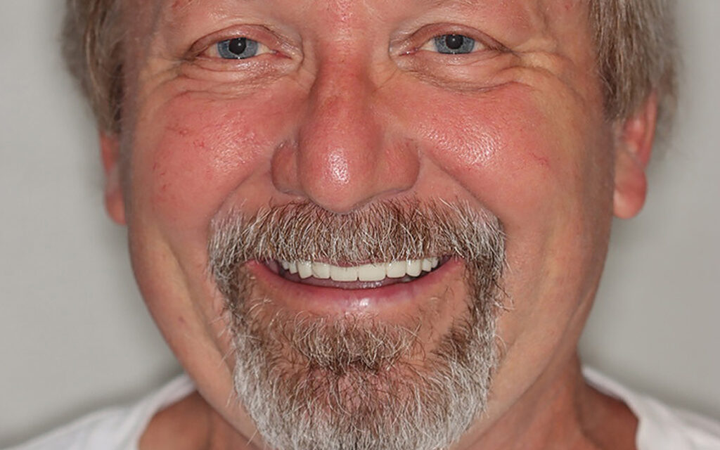 Full Arch - HCI Dentistry | Hermitage, TN